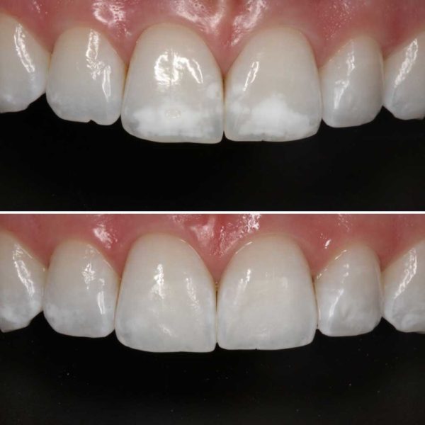 What Are Veneers? | Total Care Dental | Holistic Dentistry