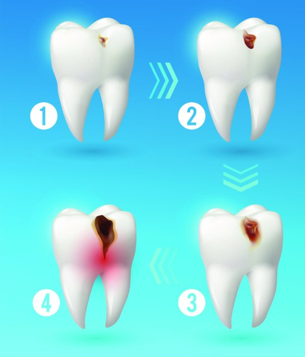 What Causes Cavities? | Total Care Dental | Holistic Dentistry