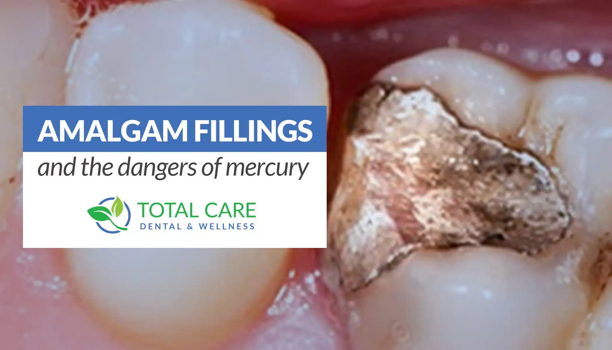 Dangers of Dental Amalgam Fillings | Total Care Dental | Holistic Dentistry